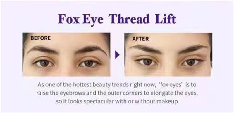 Pdo Thread Lift for Hooded Eyes, Buy Pdo Thread Lift for Hooded Eyes ...