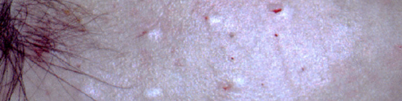 Common Complications of botulism injection - Dermax