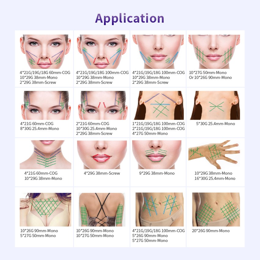 Smooth Or Barbed Pdo Thread Lift, Buy Smooth Or Barbed Pdo Thread Lift ...