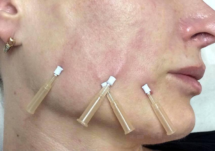 Buy Non-surgical Mini Facelift with Pdo Threads Northern CN, Non ...