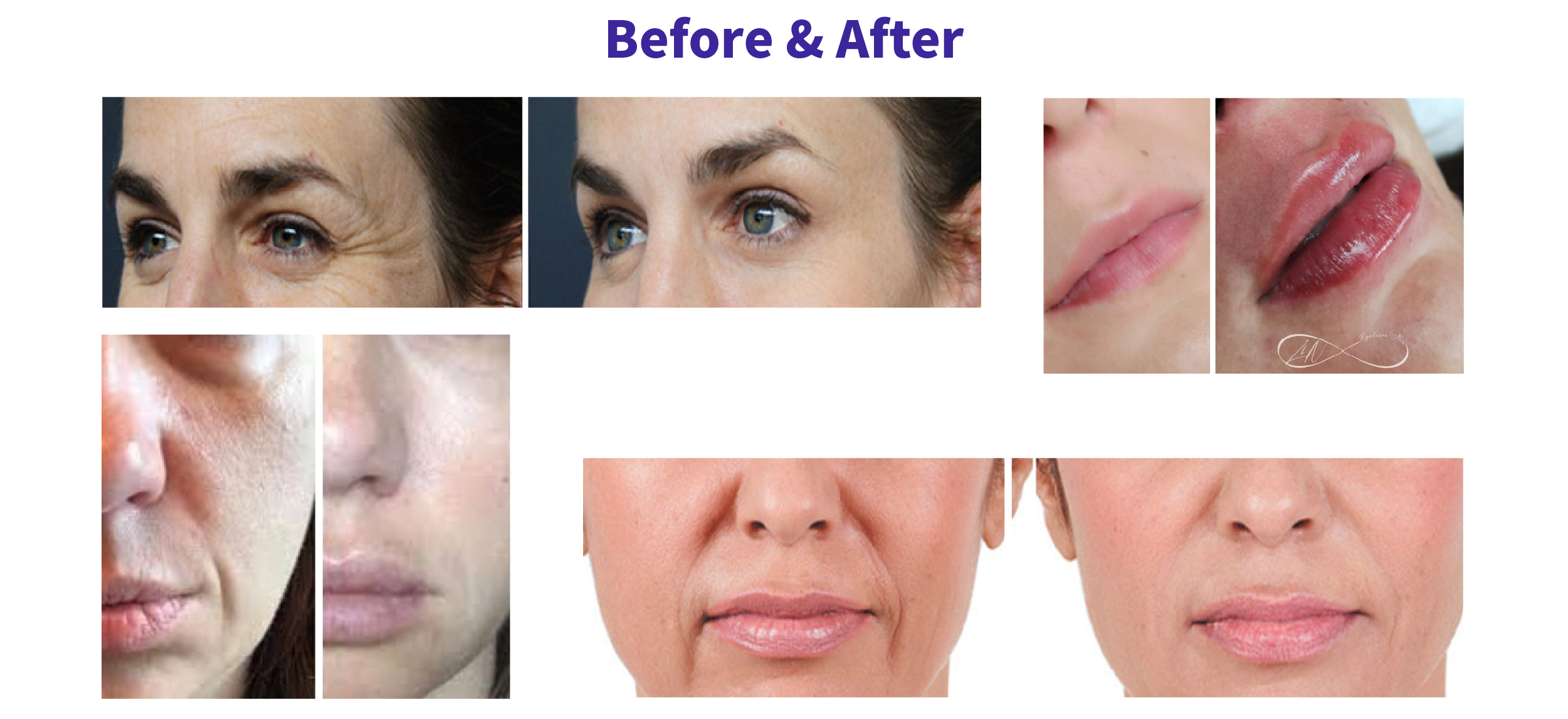 Reversal facial countering fillers and injectables - Dermax